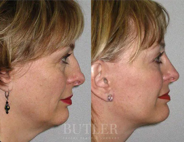 How Long Do Facelifts Last? - David M. Butler MD Plastic Surgery
